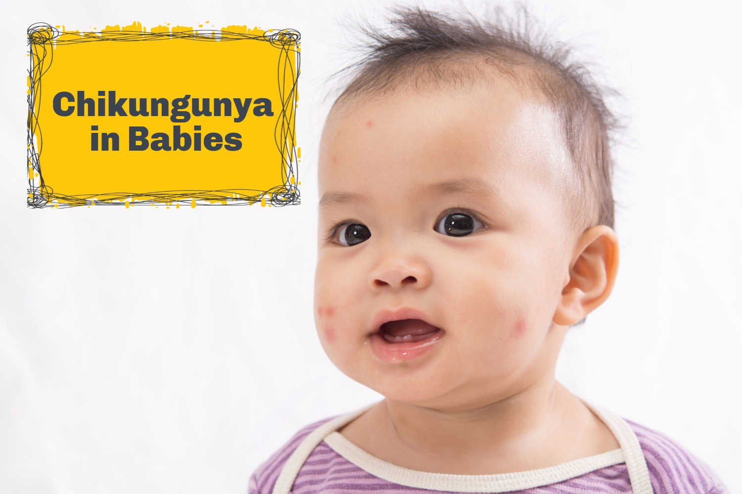 Chikungunya in Babies - Causes, Symptoms, and Treatment - Being The Parent