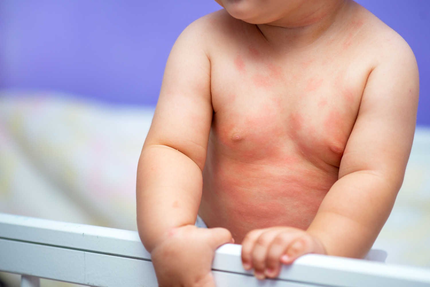 Allergies in Babies - Causes, Diagnosis and Treatment - Being The Parent