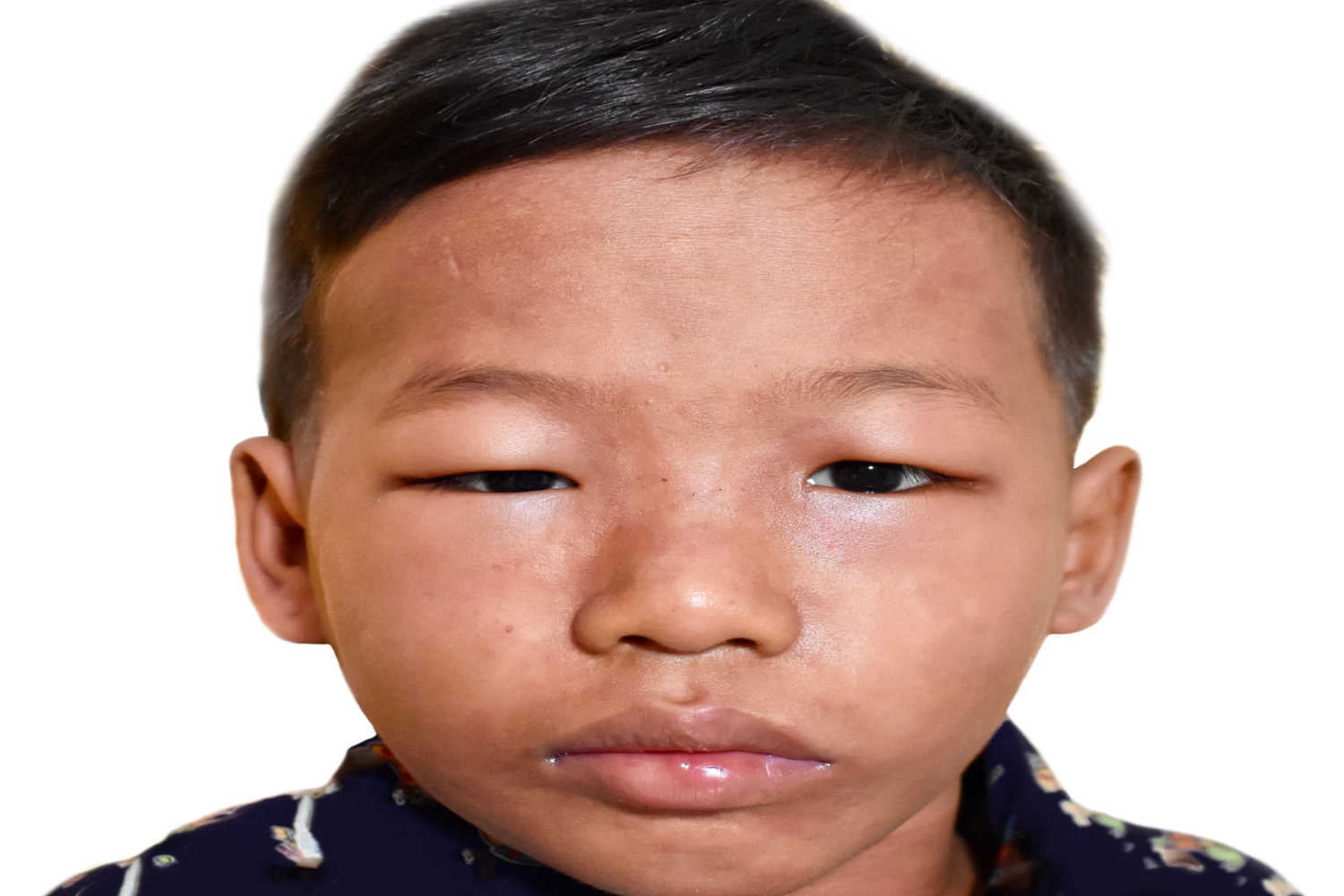 Hereditary Angioedema in Children - Types, Causes and Symptoms