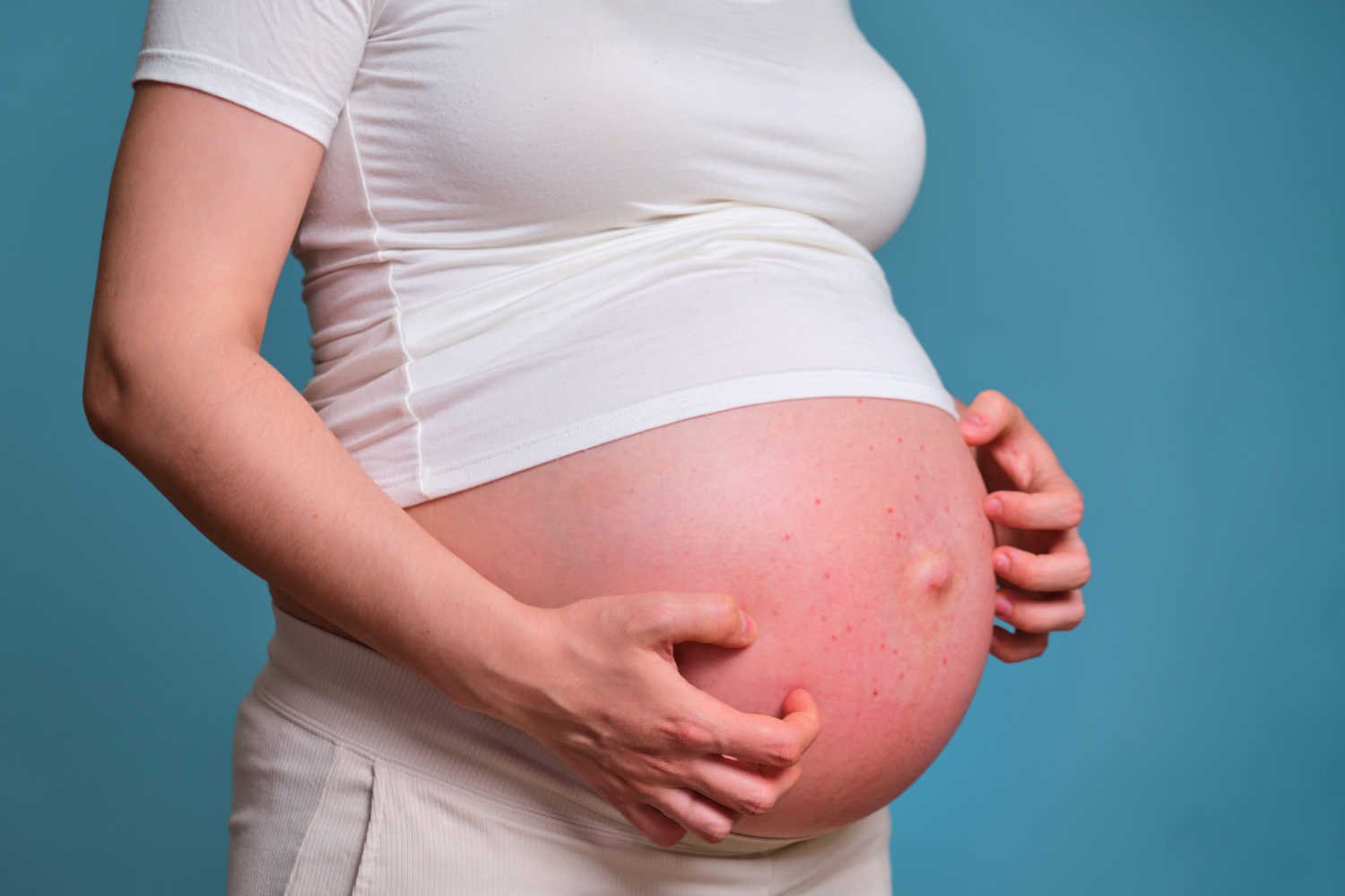 How to Choose Stretch Marks Cream During Pregnancy? - Being The Parent