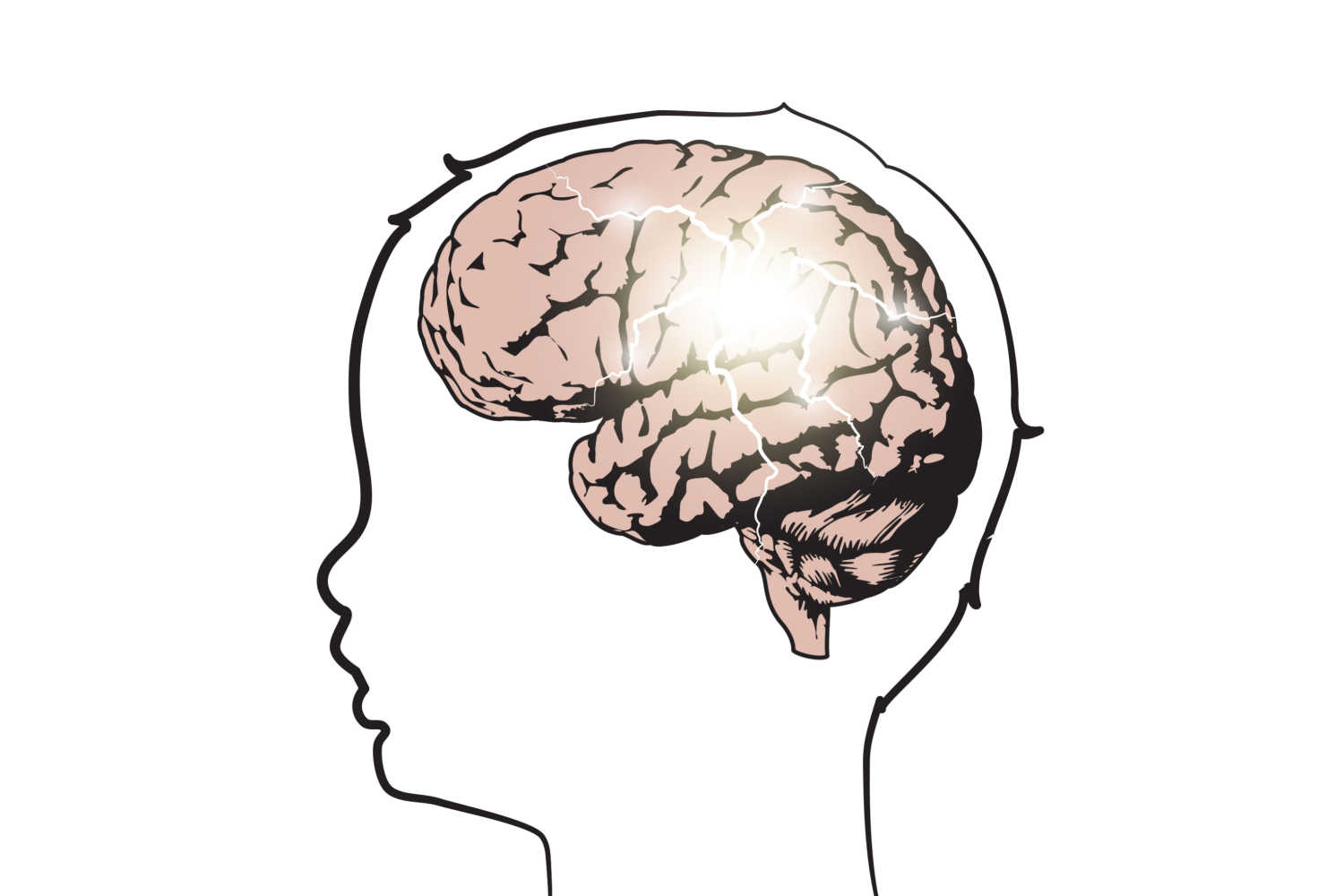 Dravet Syndrome in Babies - Causes, Symptoms, and Treatment - Being The ...