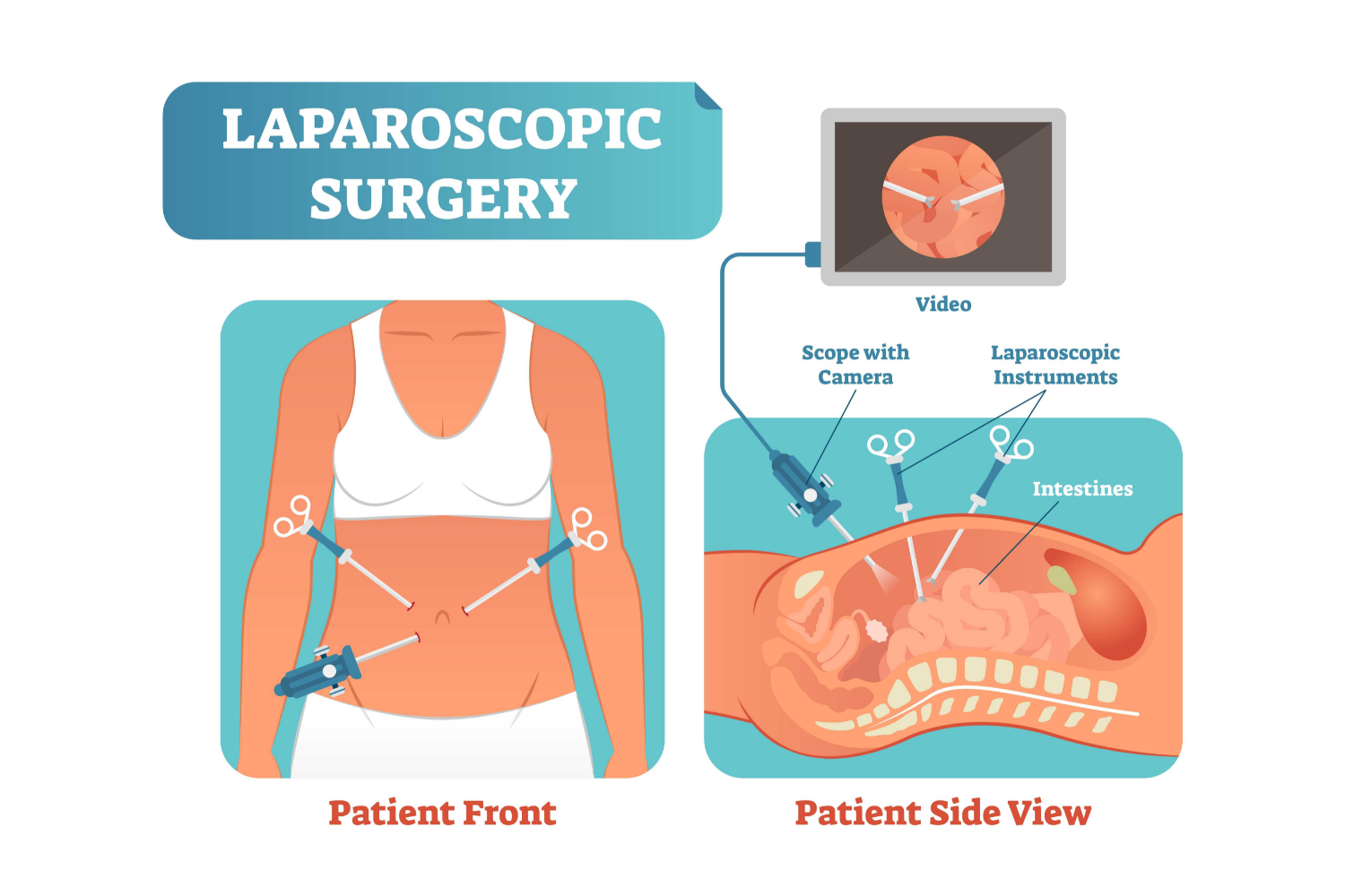 Laparoscopy For Infertility Treatment - Does it Help in Getting Pregnant? - Being The Parent