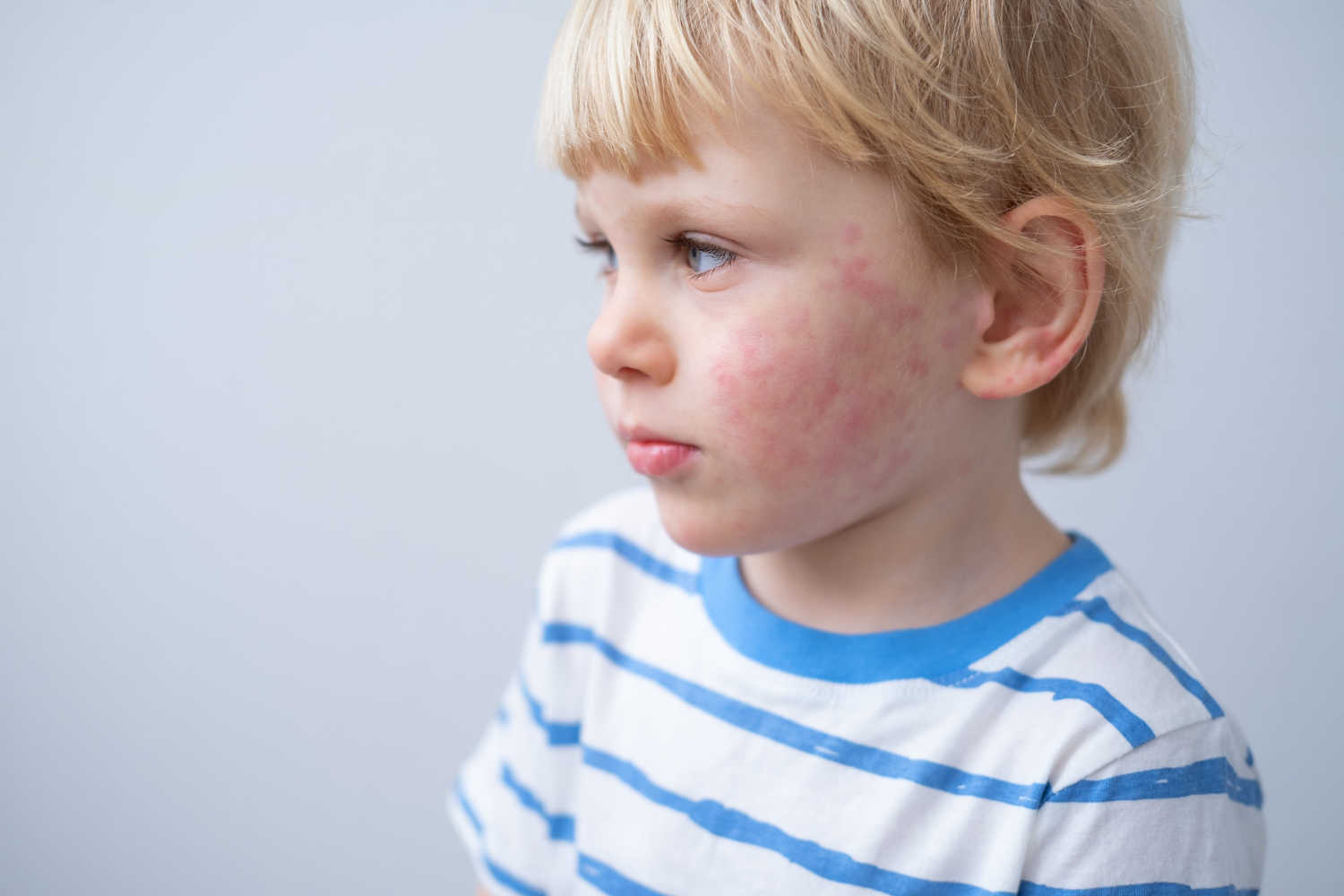 Toddler Acne - How Common and Top Tips to Prevent - Being The Parent