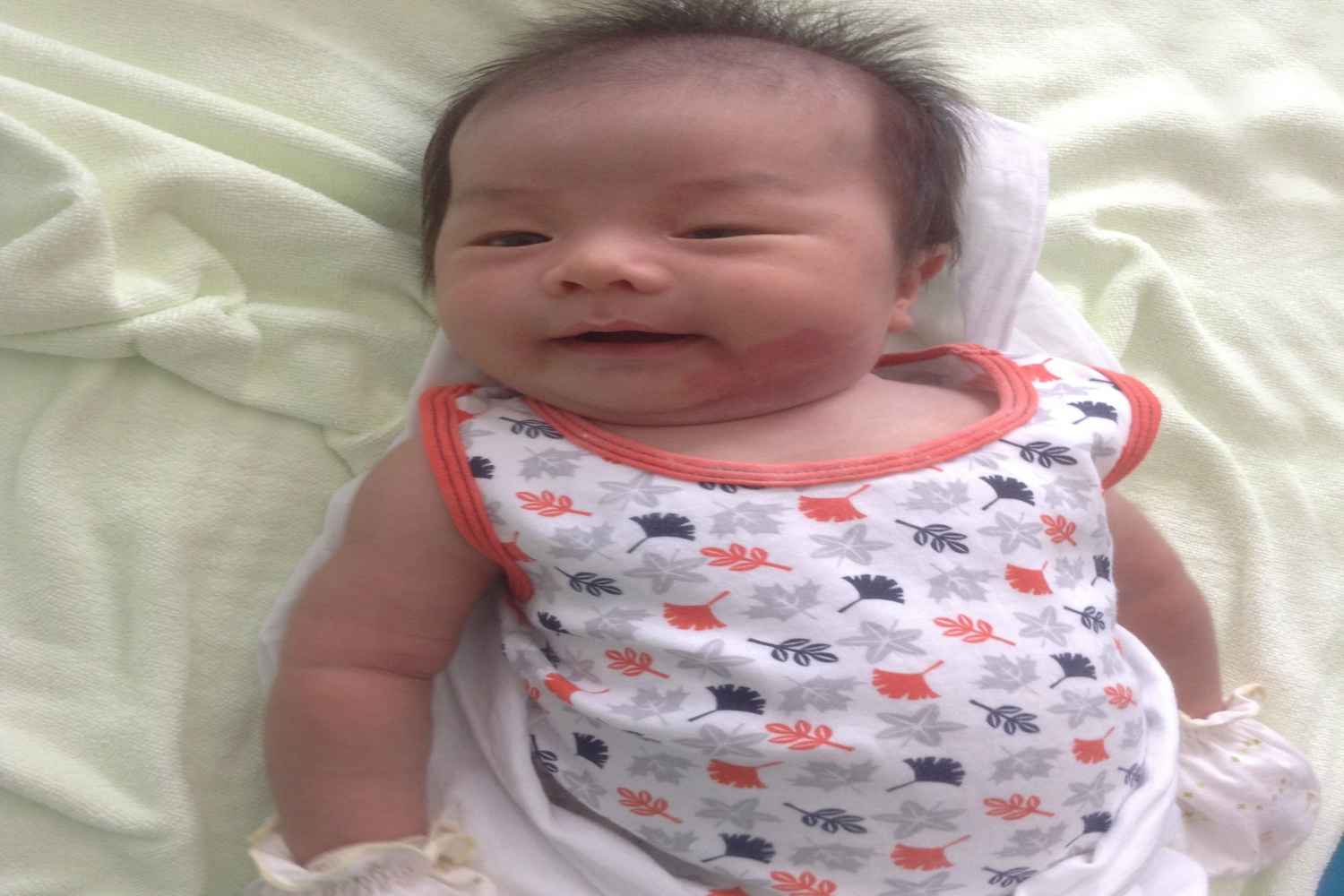 Port Wine Stain Birthmarks in Babies - Causes & Treatment