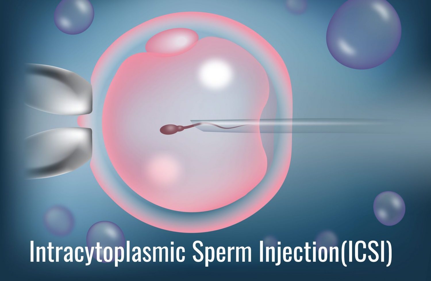 What is Intracytoplasmic Sperm Injection? - Being The Parent