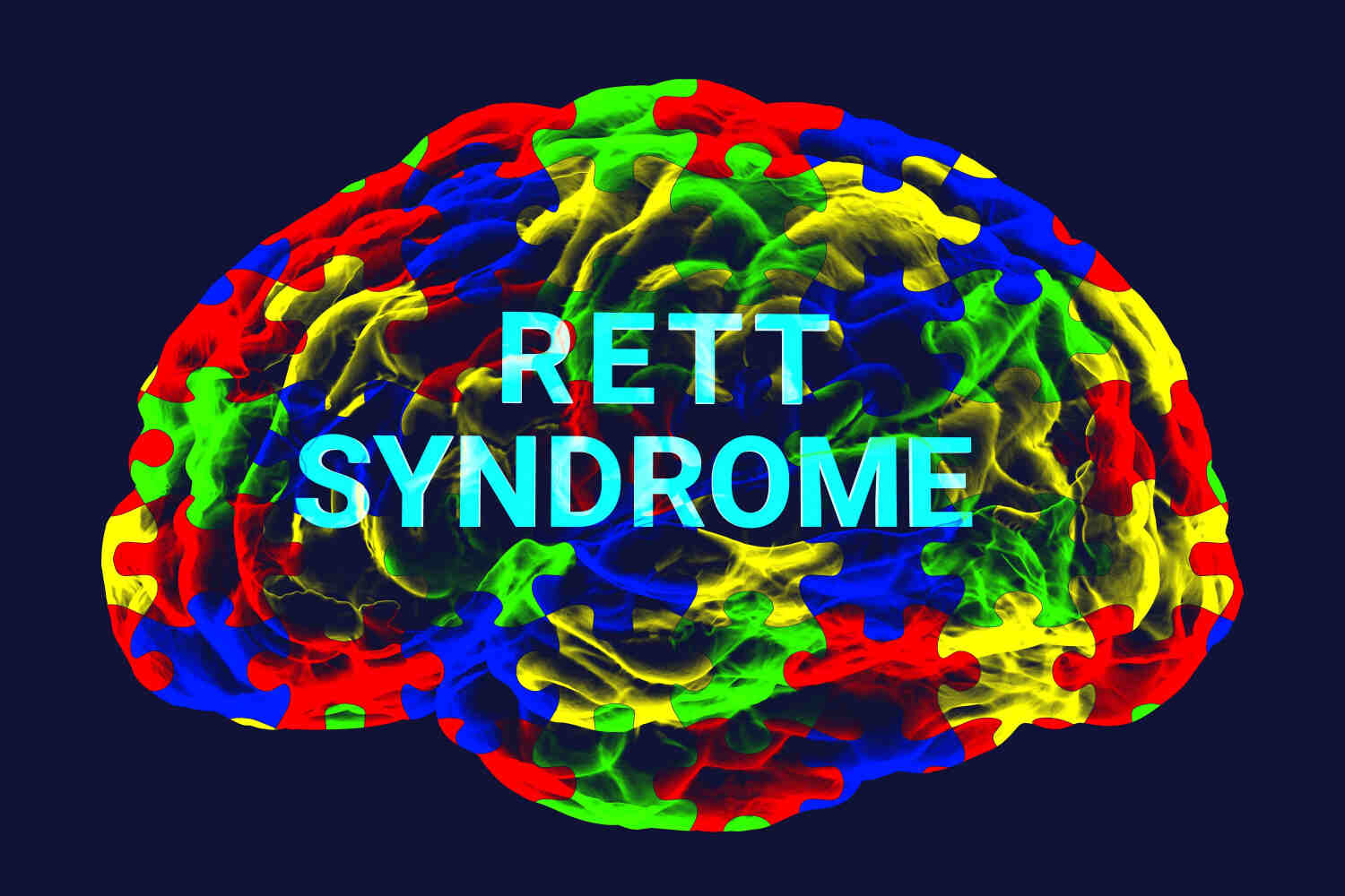 Rett Syndrome in Toddlers– Symptoms, And Treatment