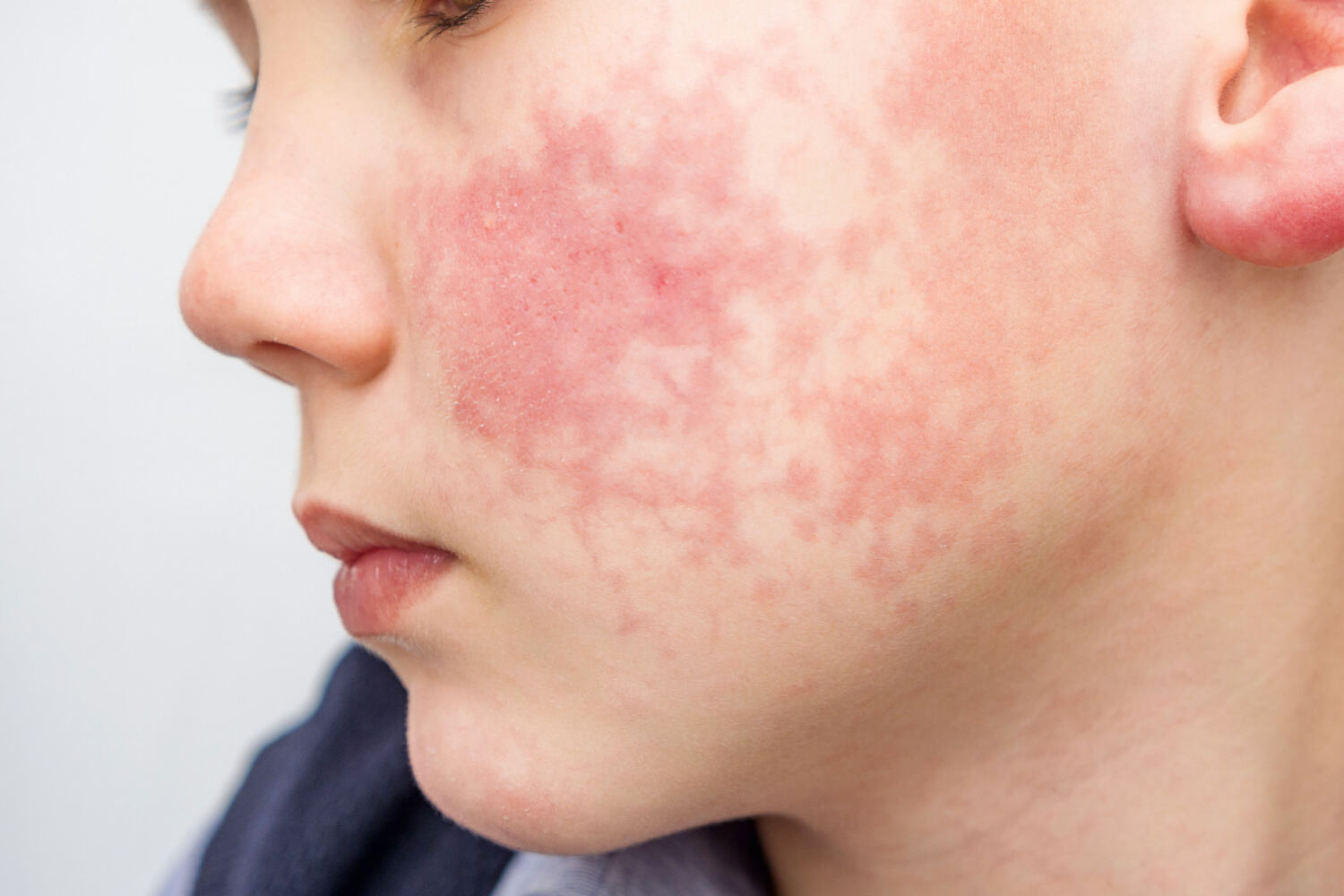 Fifth Disease in Children - What is it, Symptoms and Tips to Preven
