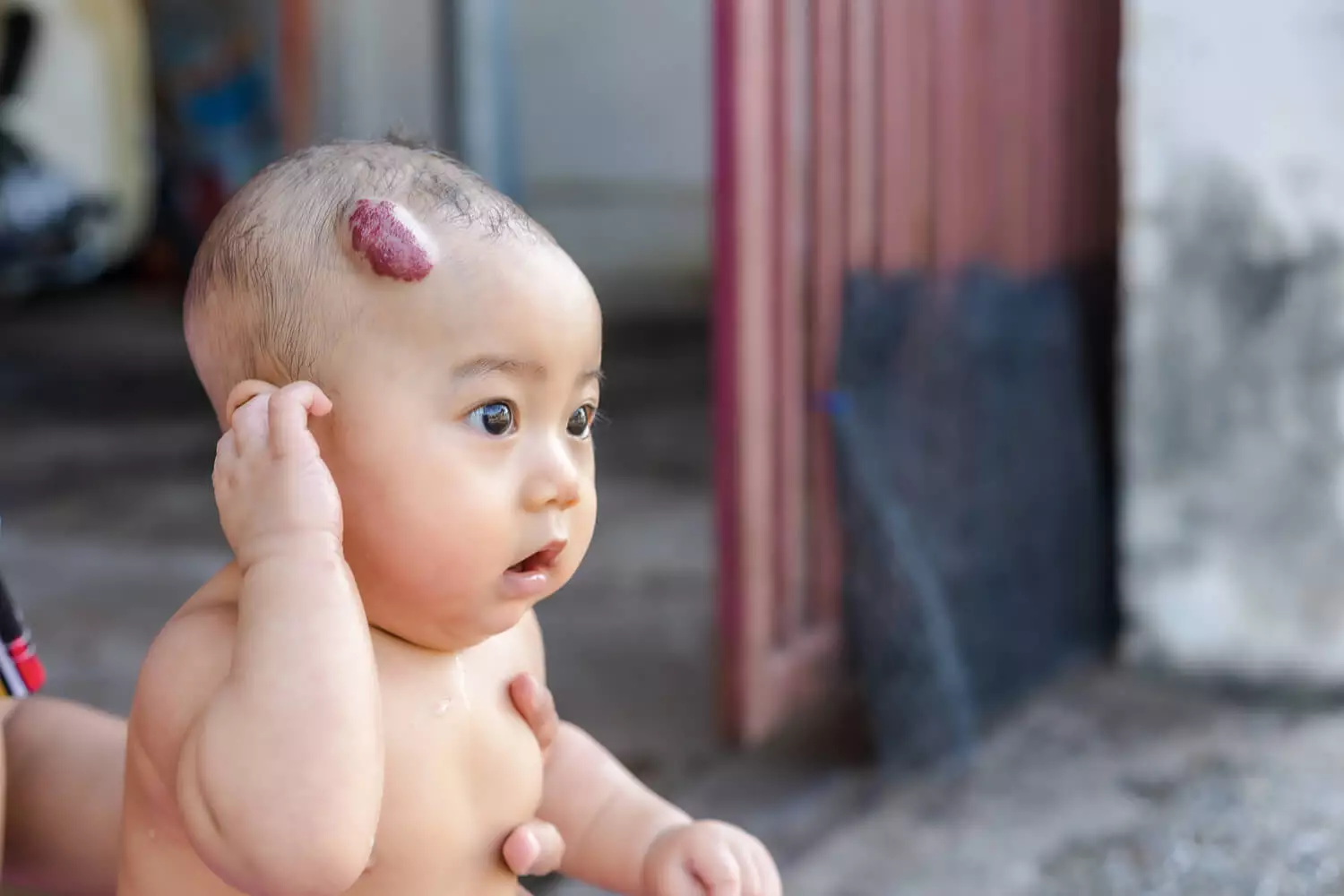 Strawberry Hemangiomas Birth Marks - Causes and When to Consult a ...