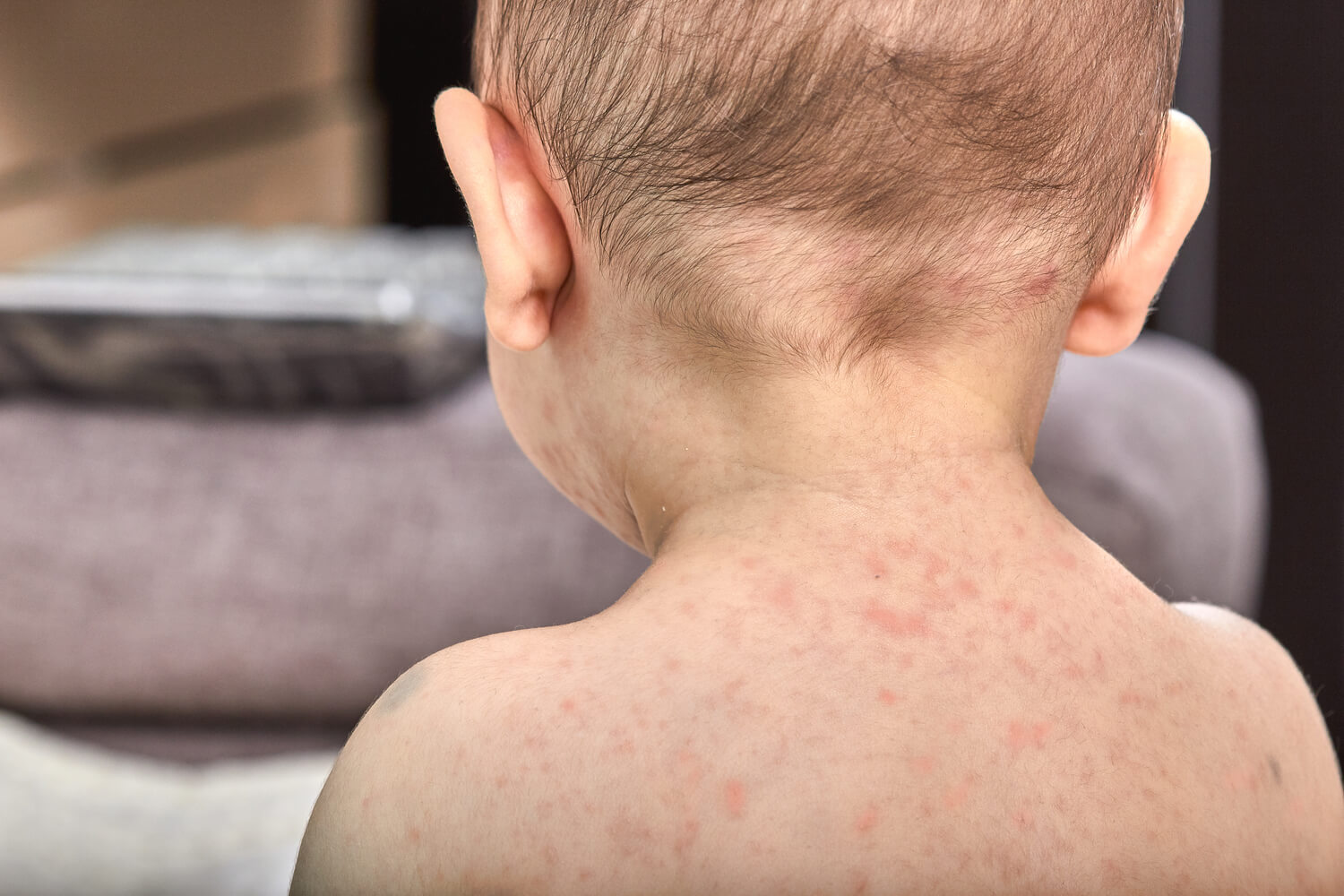 Roseola in Toddlers: Causes, Symptoms and Treatment - Being The Parent