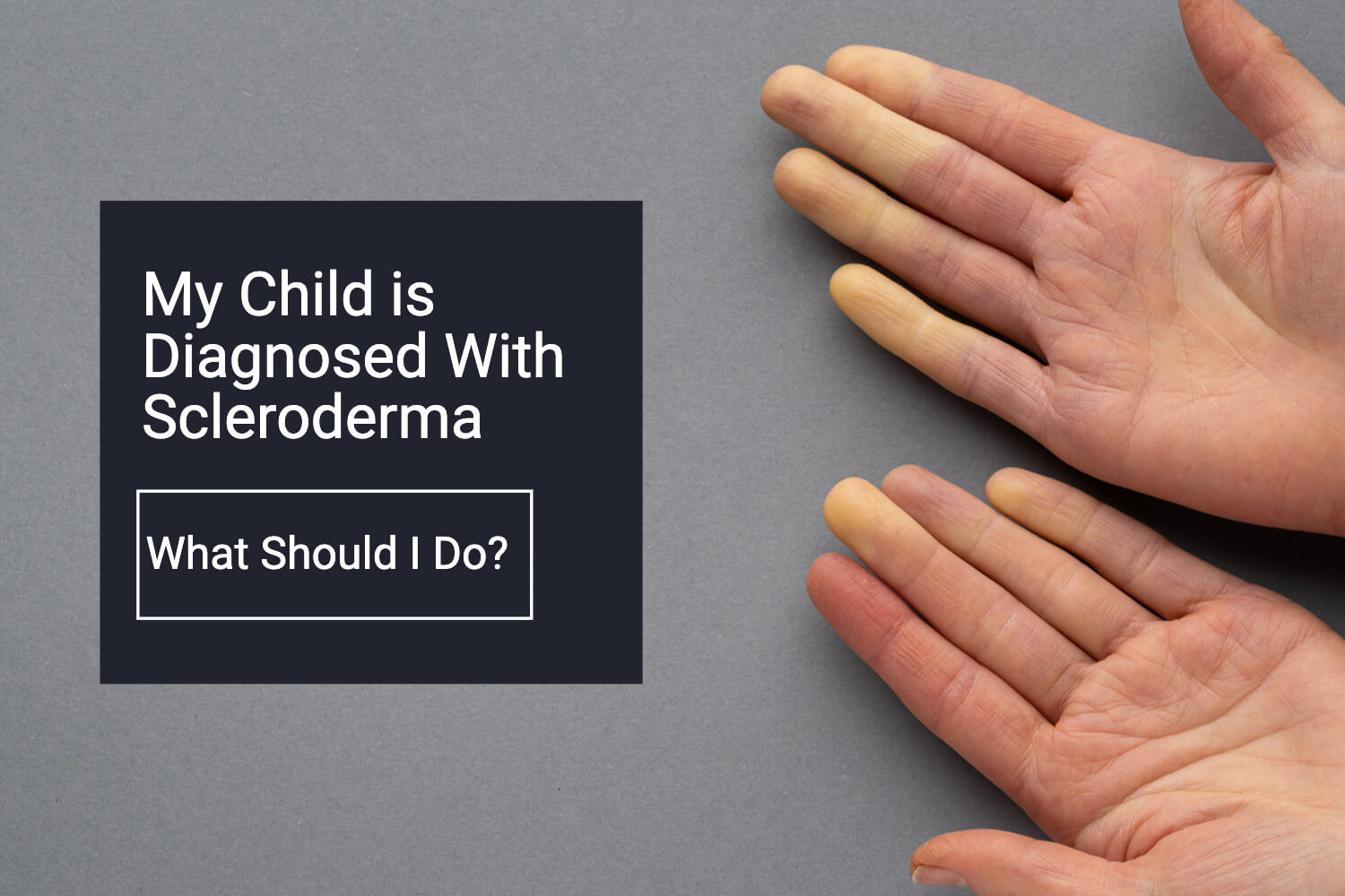 My Child is Diagnosed With Scleroderma – What Should I Do? - Being The ...