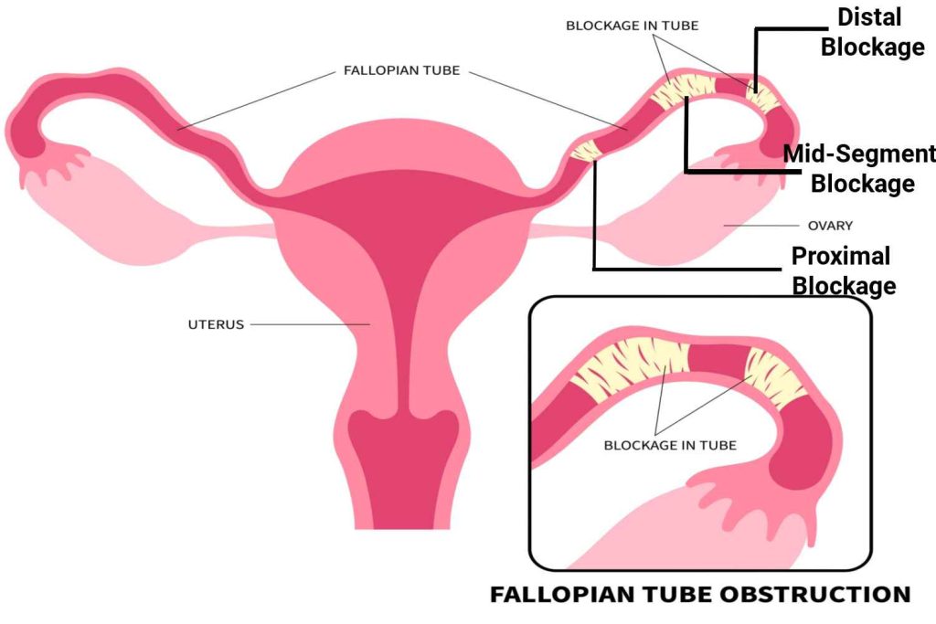 Blocked Fallopian Tubes - Types, Causes And Treatments - Being The Parent
