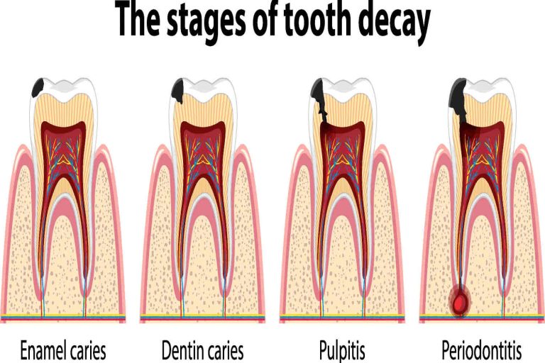 Tooth Decay in Kids - Causes, Risks, And Prevention