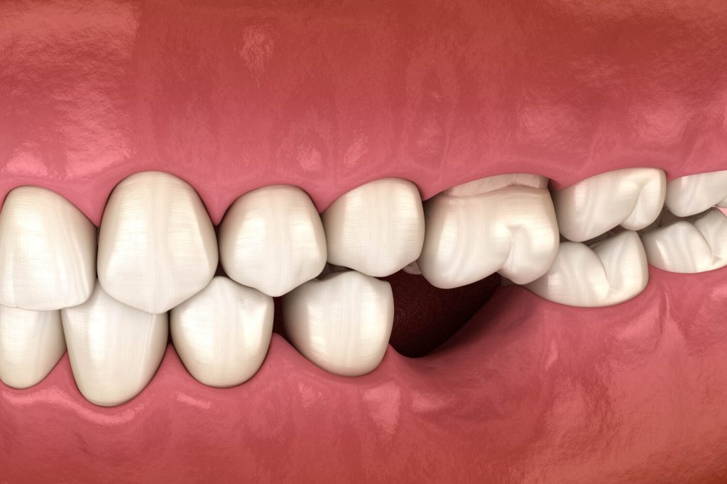 Early Loss of Baby Teeth - What to do?