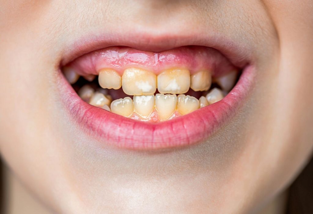 Why Do My Toddler’s Teeth Look Discolored? - Being The Parent