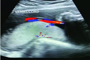 Two-Vessel Cord - Diagnosis and Risk Factors to the Baby