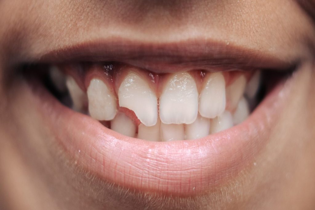 Dental Emergencies in Toddlers - Everything You Need to Know - Being ...