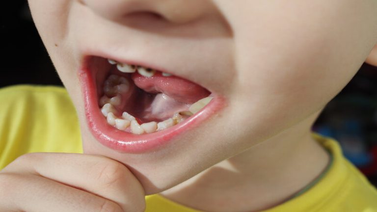 Hyperdontia In Children- Causes, Effects And Treatment- Being The Parent