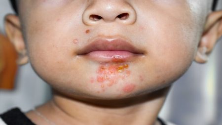 Impetigo In Children - Being The Parent