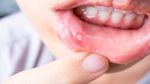 Canker Sores in Toddlers - Being The Parent