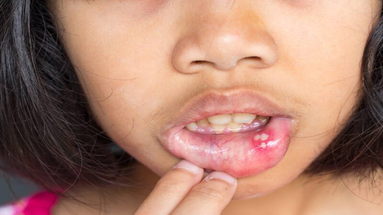 Canker Sores in Toddlers - Being The Parent